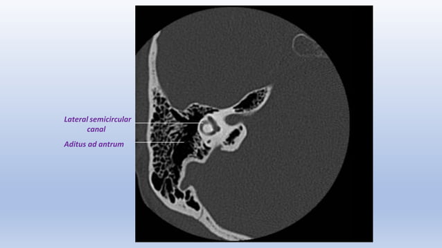 Hrct temporal bone pk1 ppt | PPTX