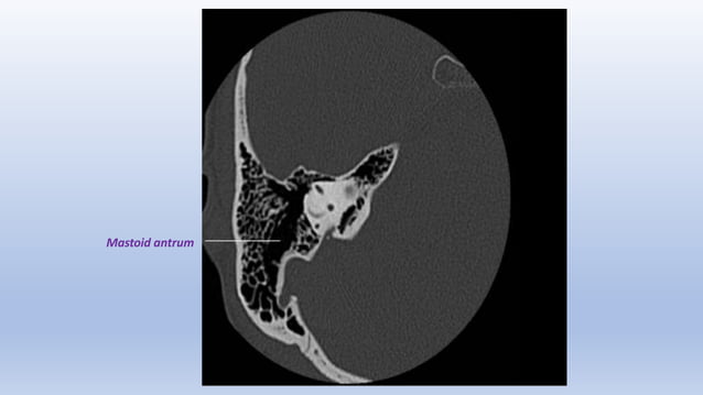 Hrct temporal bone pk1 ppt | PPTX