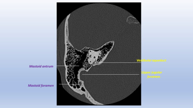 Hrct temporal bone pk1 ppt | PPTX