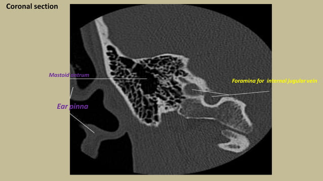 Hrct temporal bone pk1 ppt | PPTX