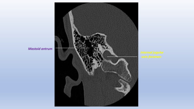 Hrct temporal bone pk1 ppt | PPTX
