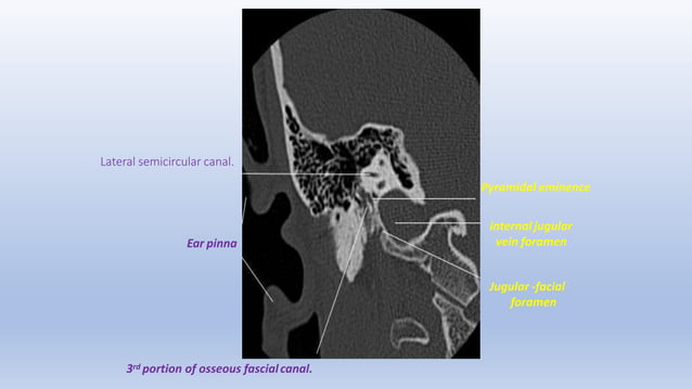Hrct temporal bone pk1 ppt | PPTX