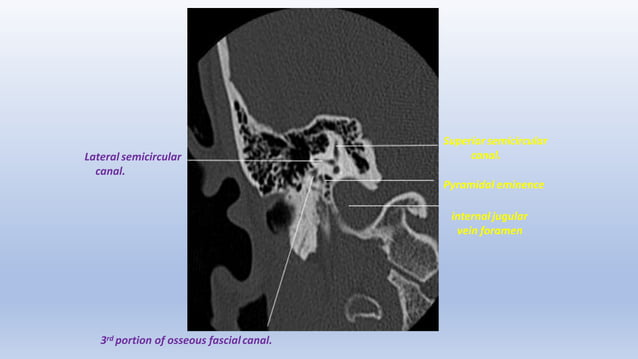 Hrct temporal bone pk1 ppt | PPTX