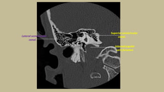 Hrct temporal bone pk1 ppt | PPTX