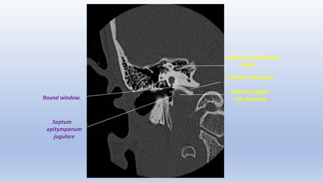 Hrct temporal bone pk1 ppt | PPTX