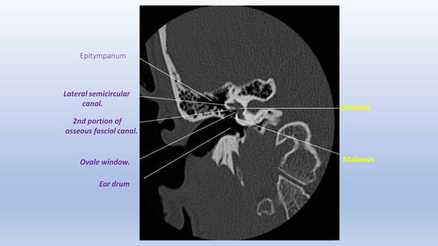 Hrct temporal bone pk1 ppt | PPTX