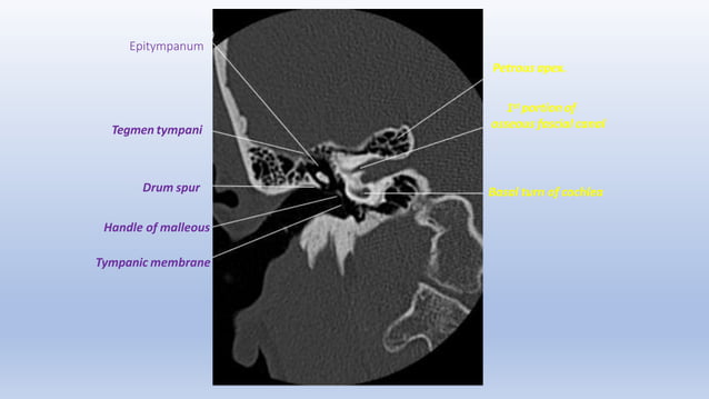 Hrct temporal bone pk1 ppt | PPTX