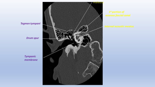 Hrct temporal bone pk1 ppt | PPTX