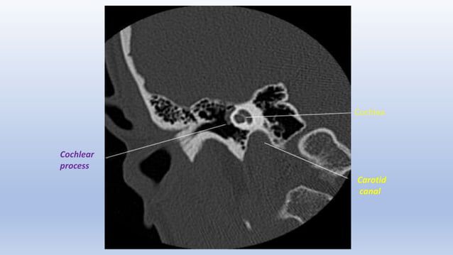 Hrct temporal bone pk1 ppt | PPTX