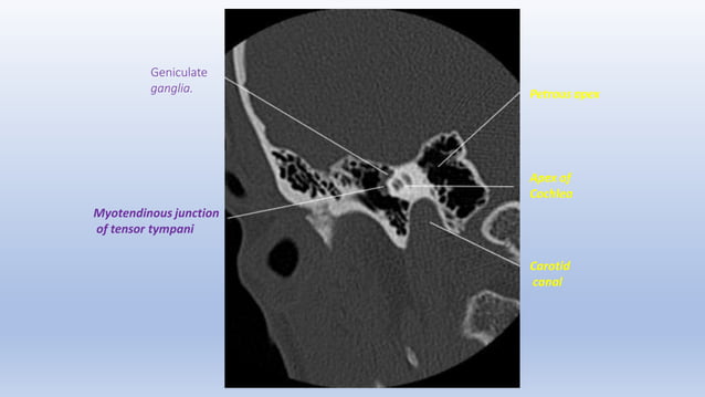 Hrct temporal bone pk1 ppt | PPTX