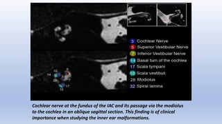 Hrct temporal bone pk1 ppt | PPTX