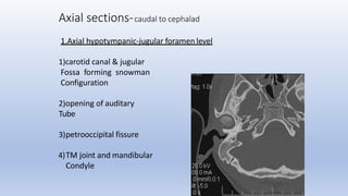 Hrct temporal bone pk1 ppt | PPTX