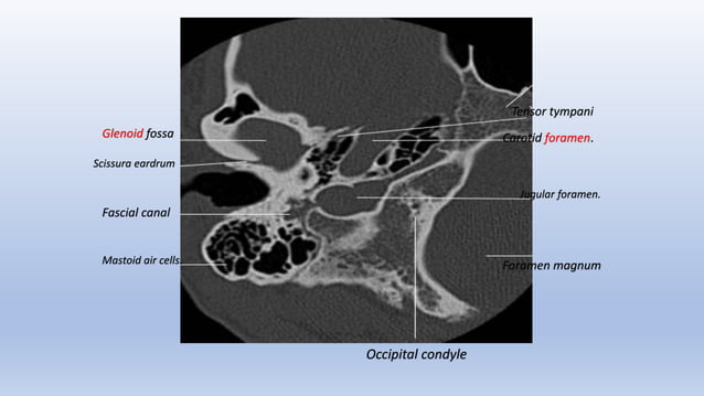Hrct temporal bone pk1 ppt | PPTX