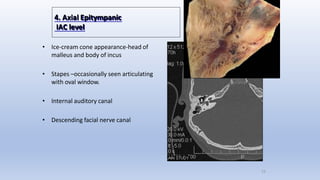 Hrct temporal bone pk1 ppt | PPTX