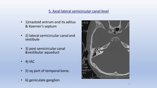 Hrct temporal bone pk1 ppt | PPTX