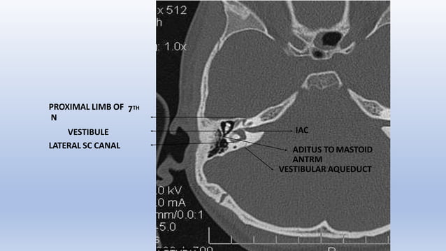 Hrct temporal bone pk1 ppt