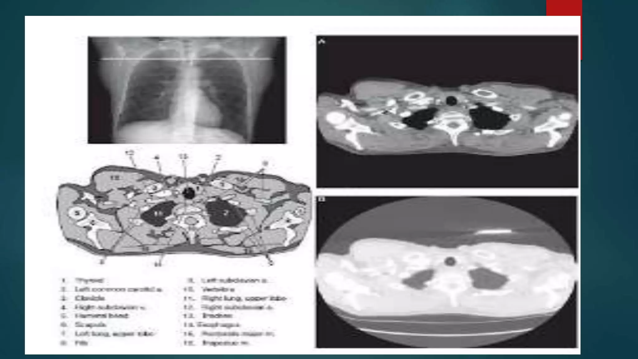HRCT Thorax (High resolution computed tomography).pptx
