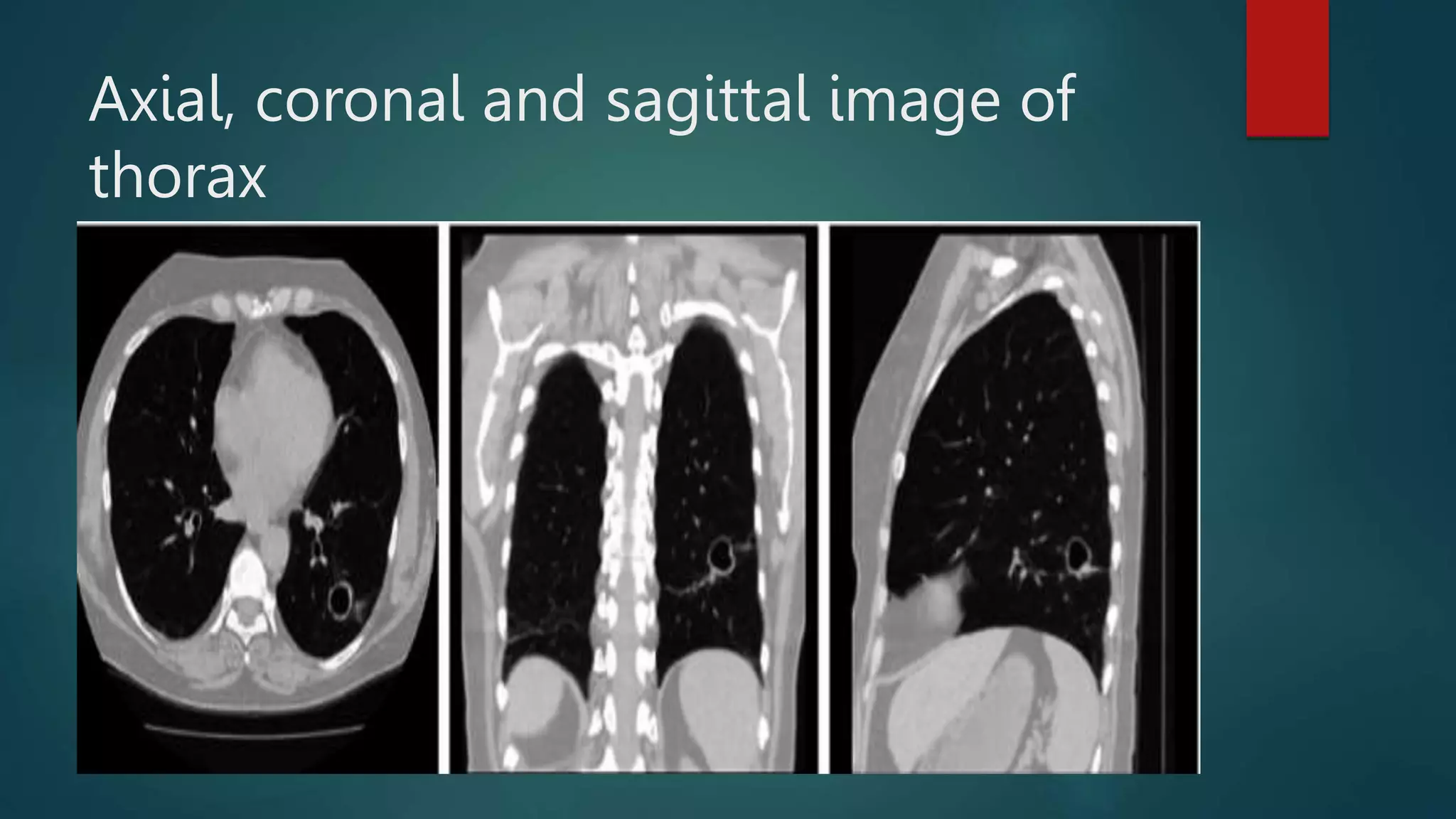 HRCT Thorax (High resolution computed tomography).pptx