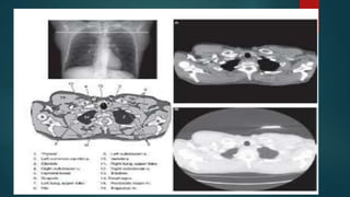 HRCT Thorax (High resolution computed tomography).pptx