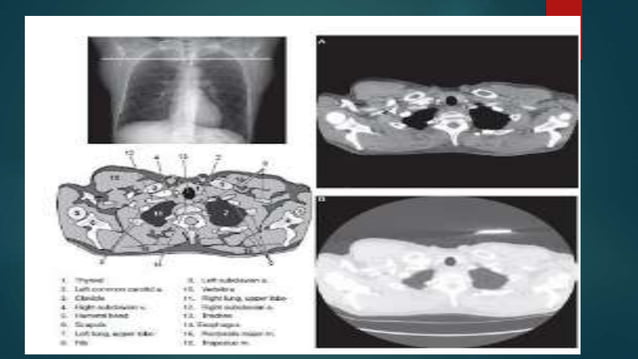 HRCT Thorax (High resolution computed tomography).pptx