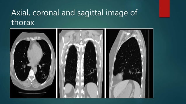 HRCT Thorax (High resolution computed tomography).pptx