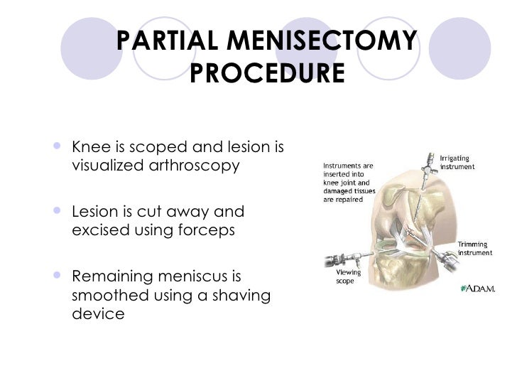 Meniscal Repair Surgical Techniques