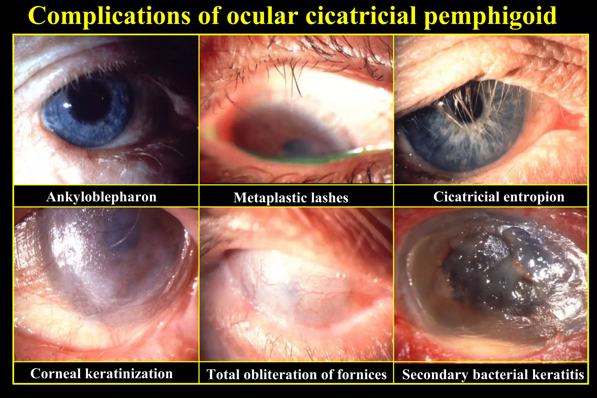11 immunobullous diseases | PPT