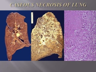 Caseous Necrosis Gross