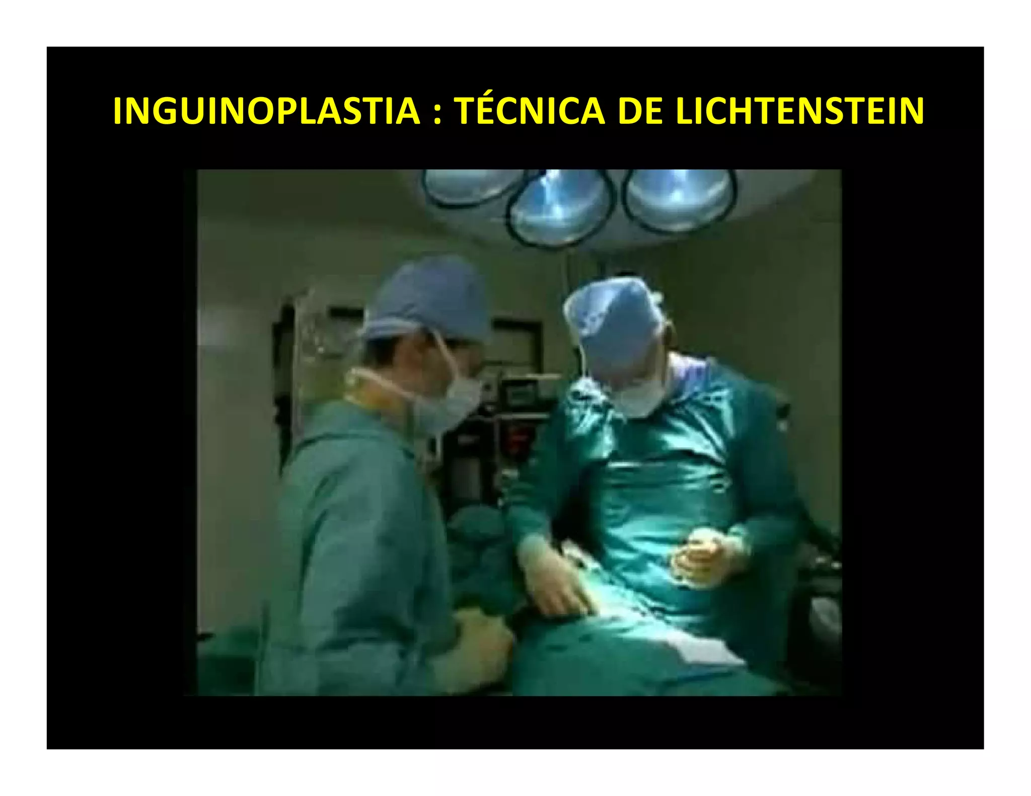 Técnica de Lichtenstein nas Inguinoplastias | PDF