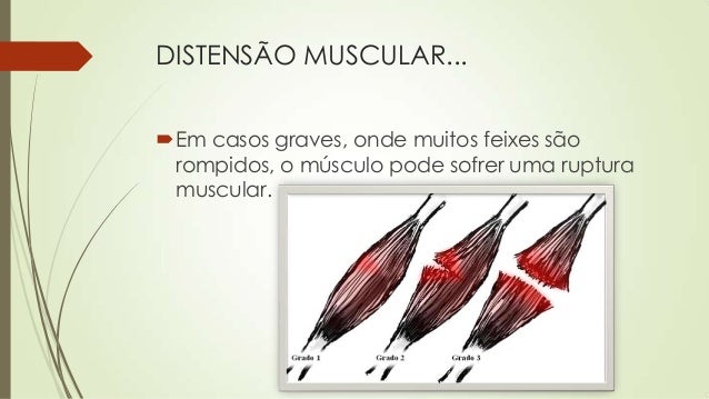 Hérnia de disco e distensão muscular