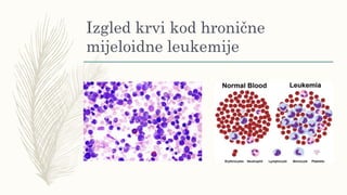 Hronična mijeloidna i limfatična leukemija - interna medicina | PPTX
