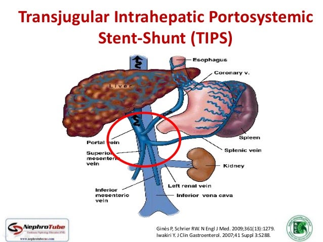 Is it Hepato-Renal Syndrome?