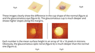 Heidelberg retinal tomography Introduction to interpretation | PPTX