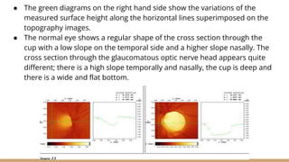 Heidelberg retinal tomography Introduction to interpretation | PPTX