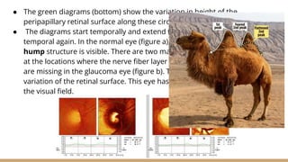 Heidelberg retinal tomography Introduction to interpretation | PPTX