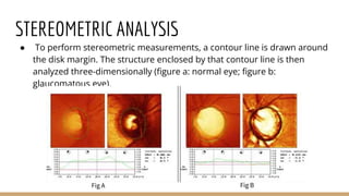 Heidelberg retinal tomography Introduction to interpretation | PPTX