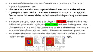 Heidelberg retinal tomography Introduction to interpretation | PPTX