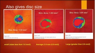 Heidelberg retinal tomography Introduction to interpretation | PPTX