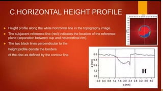 Heidelberg retinal tomography Introduction to interpretation | PPTX
