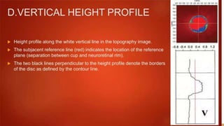 Heidelberg retinal tomography Introduction to interpretation | PPTX