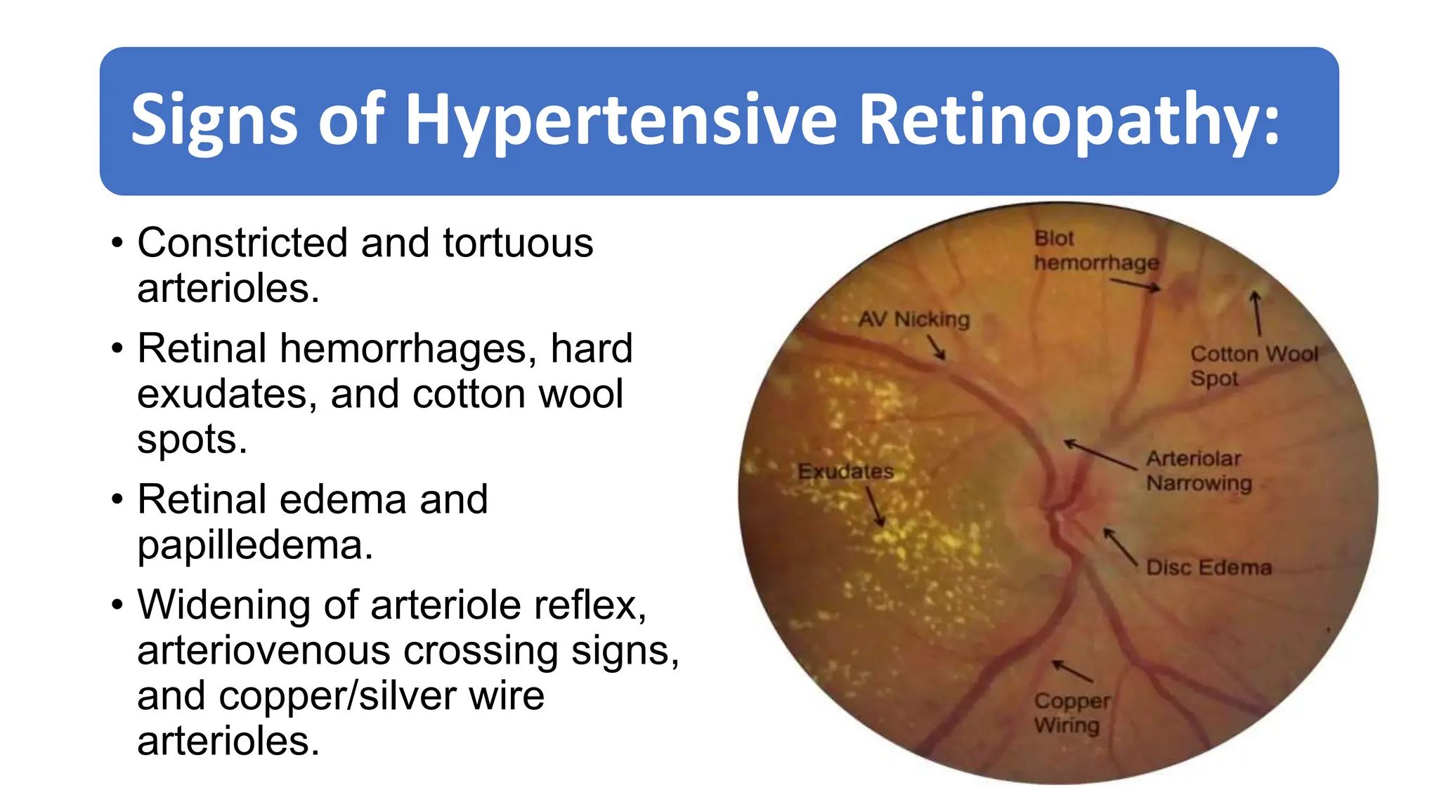 Hypertensive Retinopathy.pptx
