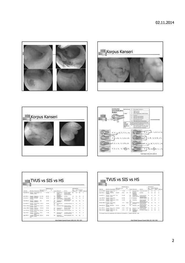 Hysteroscopy for abnormal uterine bleeding | PDF