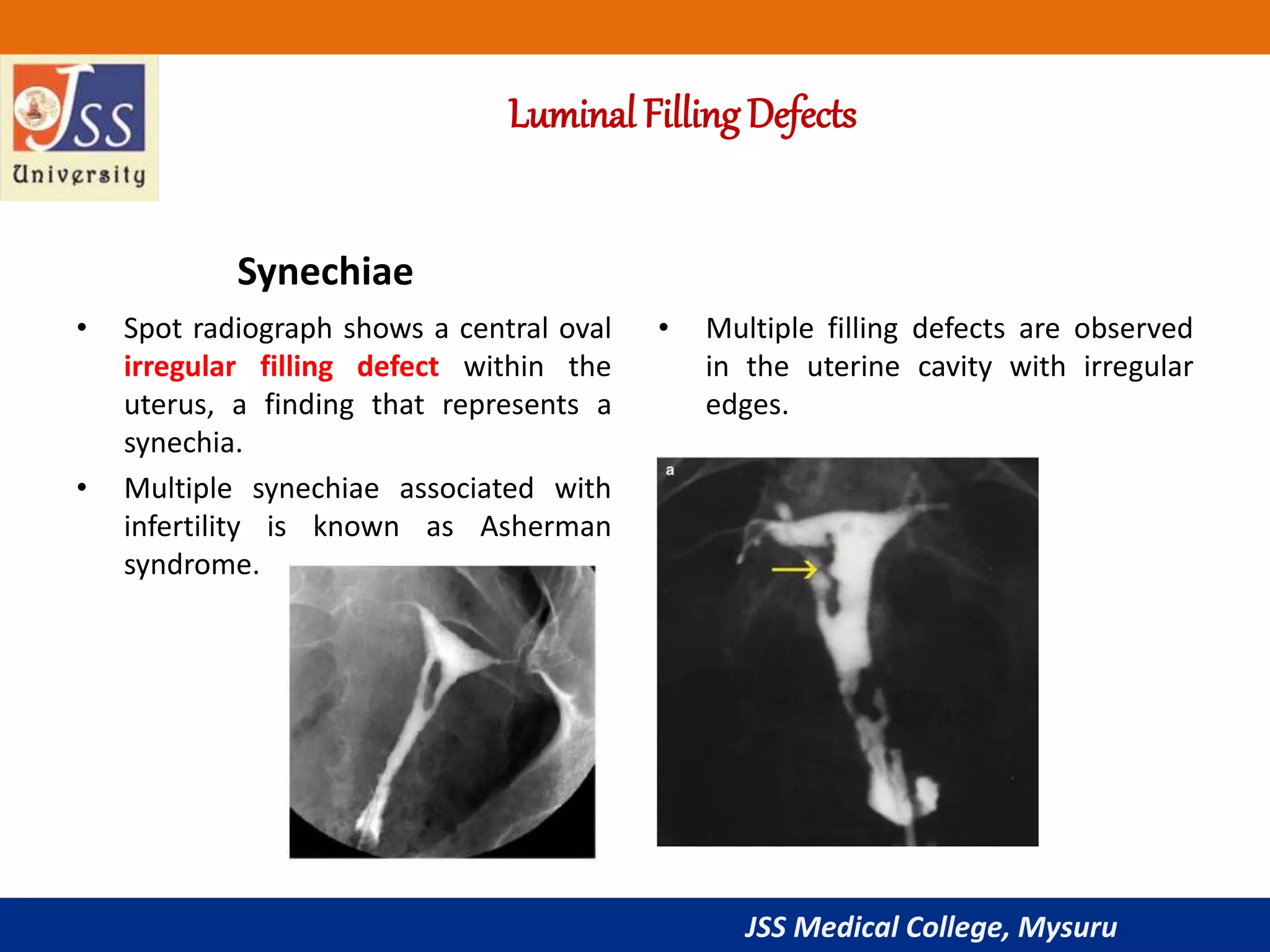 Hysterosalphyngography | PPTX