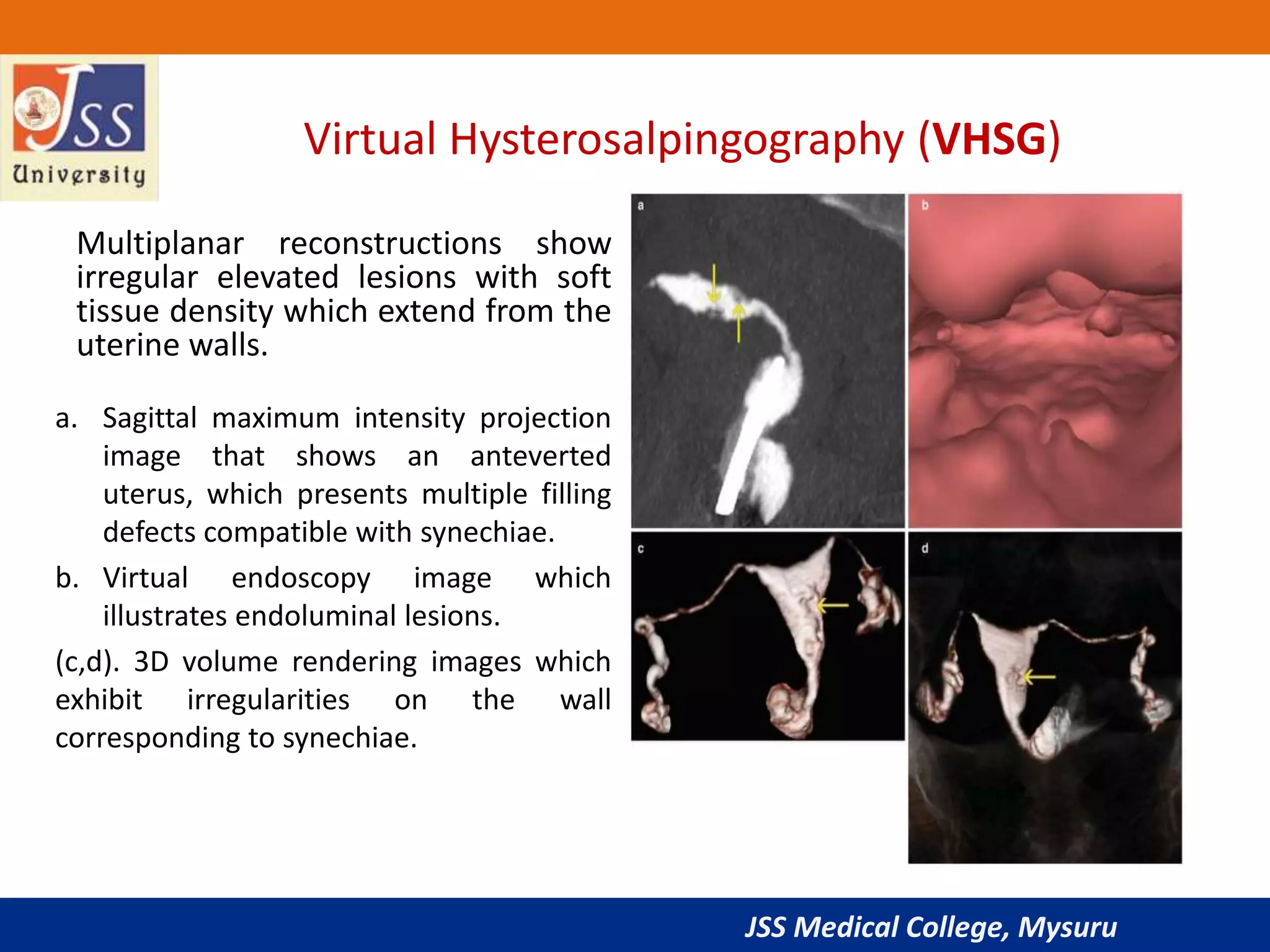 Hysterosalphyngography | PPTX