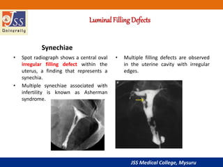 Hysterosalphyngography | PPTX