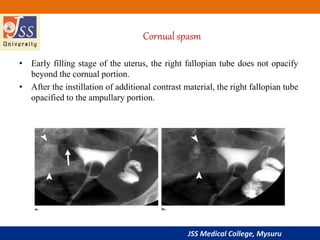 Hysterosalphyngography | PPTX
