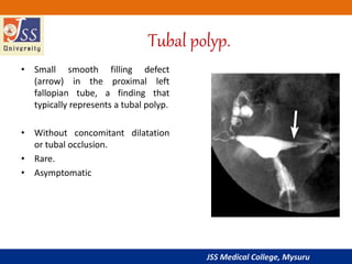 Hysterosalphyngography | PPTX
