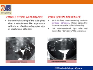 Hysterosalphyngography | PPTX