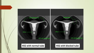 HSG.hysteriosalpingiography | PPT