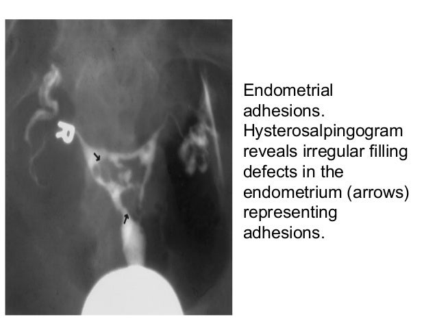 Hysterosalpingography cases
